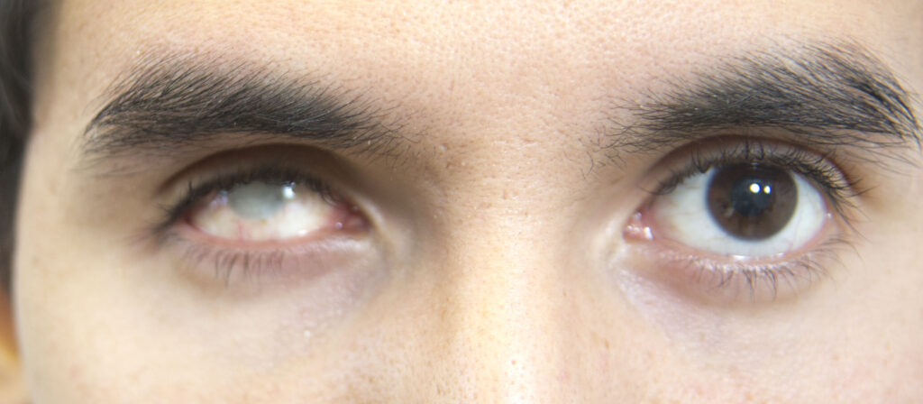 Eye Loss - Advanced Artificial Eyes